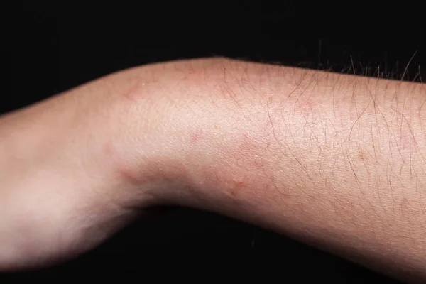 Dog bite wound and scar with dark background Stock Photo by ...