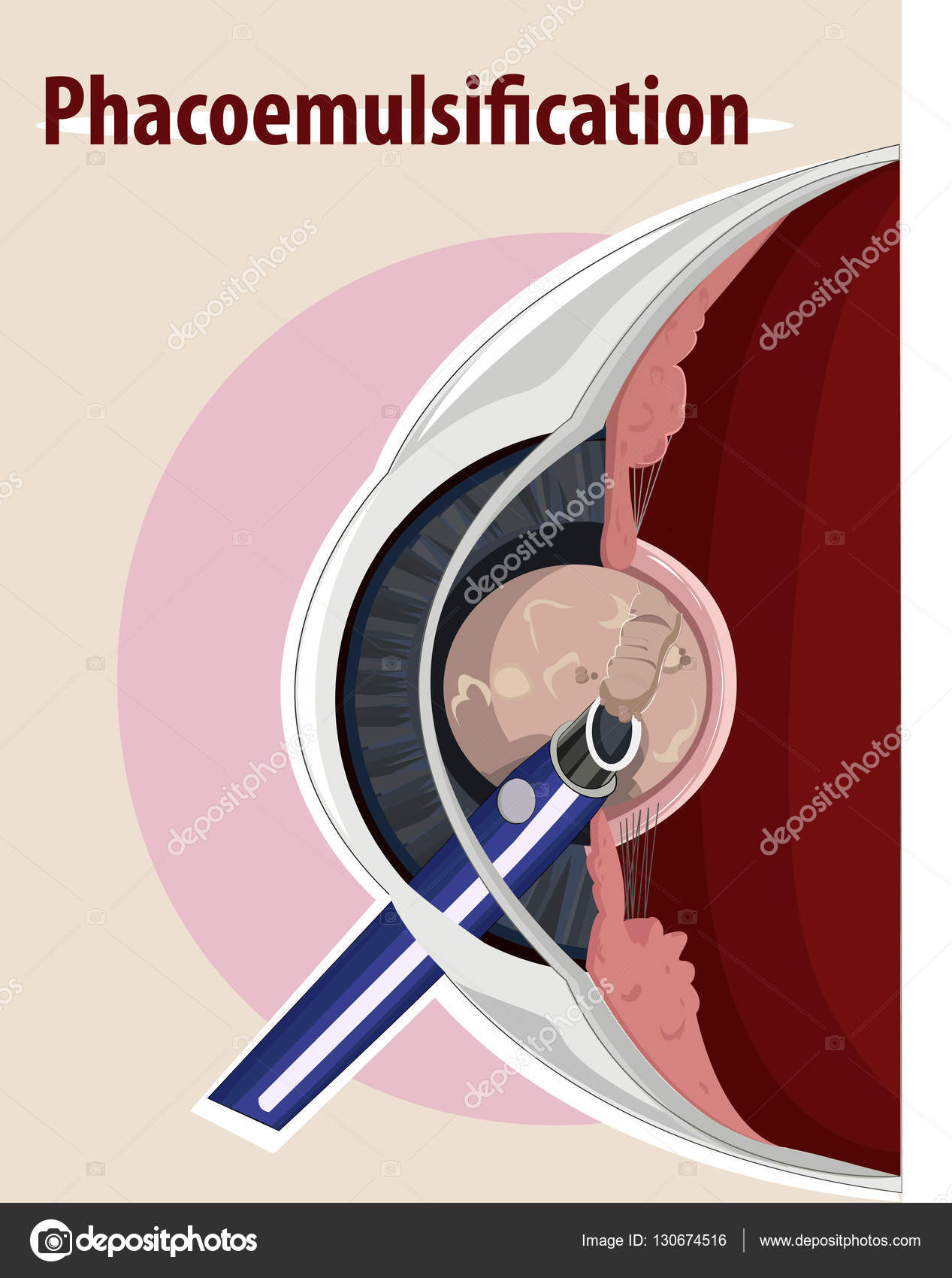 Vector Cataract surgery Stock Vector Image by ©magemasher #130674516