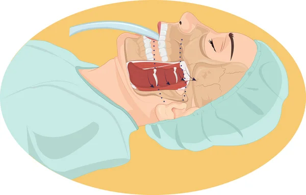 195 Intubation vector Vector Images - Free & Royalty-free Intubation ...