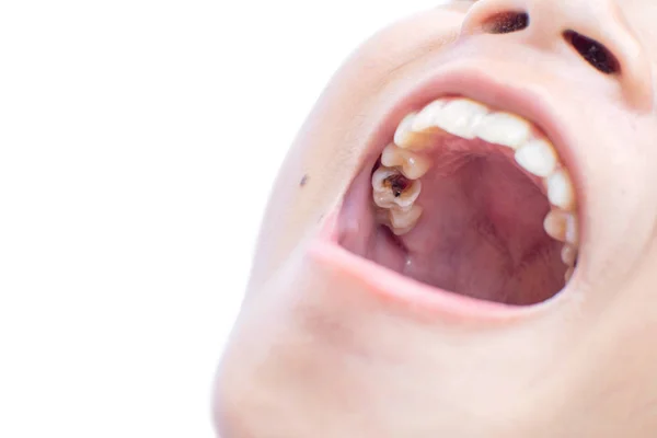 ᐈ Dientes podridos imágenes de stock, fotos dientes picados | descargar ...