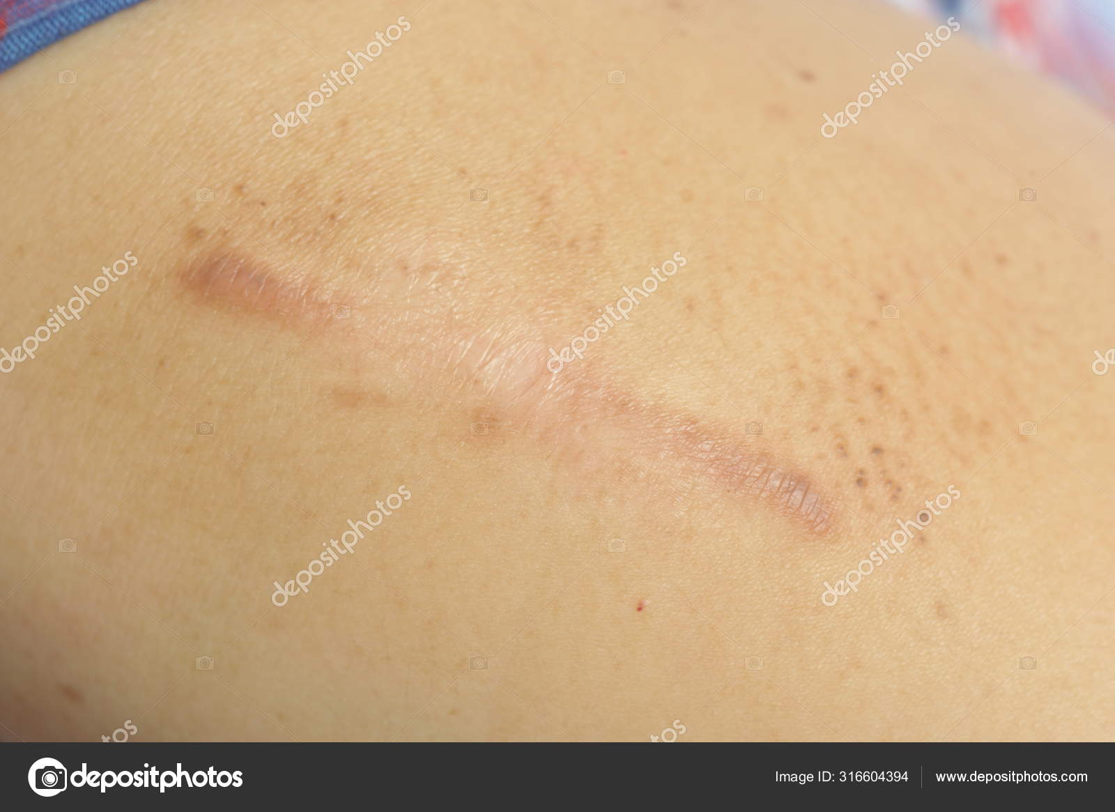 Scar a permanent effect on someones mind, caused by an unpleasant ...