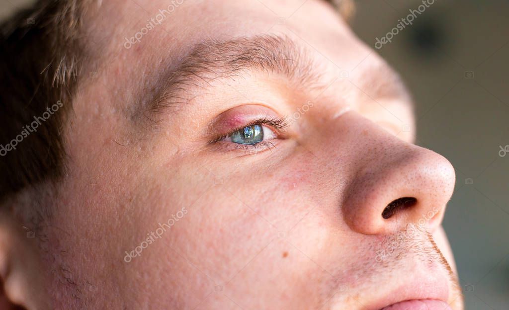 Enfoque selectivo en el párpado superior rojo hinchado y doloroso con ...