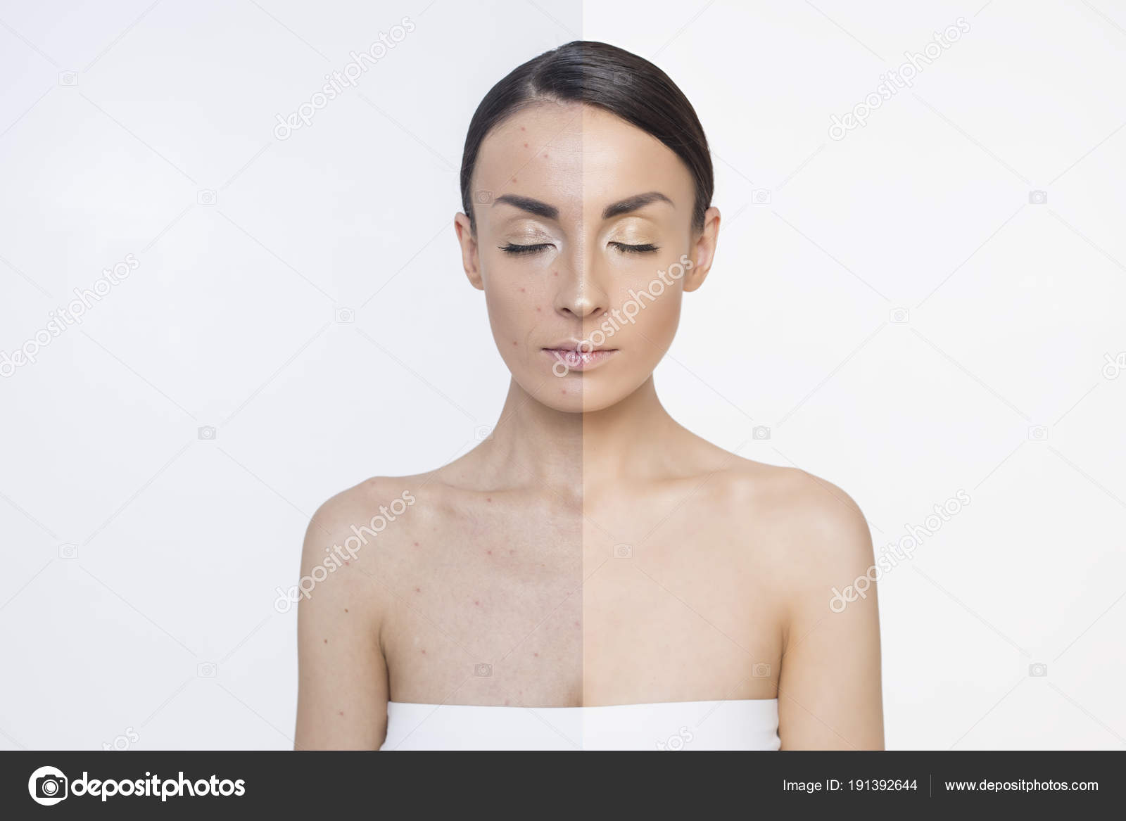 Acne Skin Problems Two Different Halves Face Close Portrait Beautiful ...