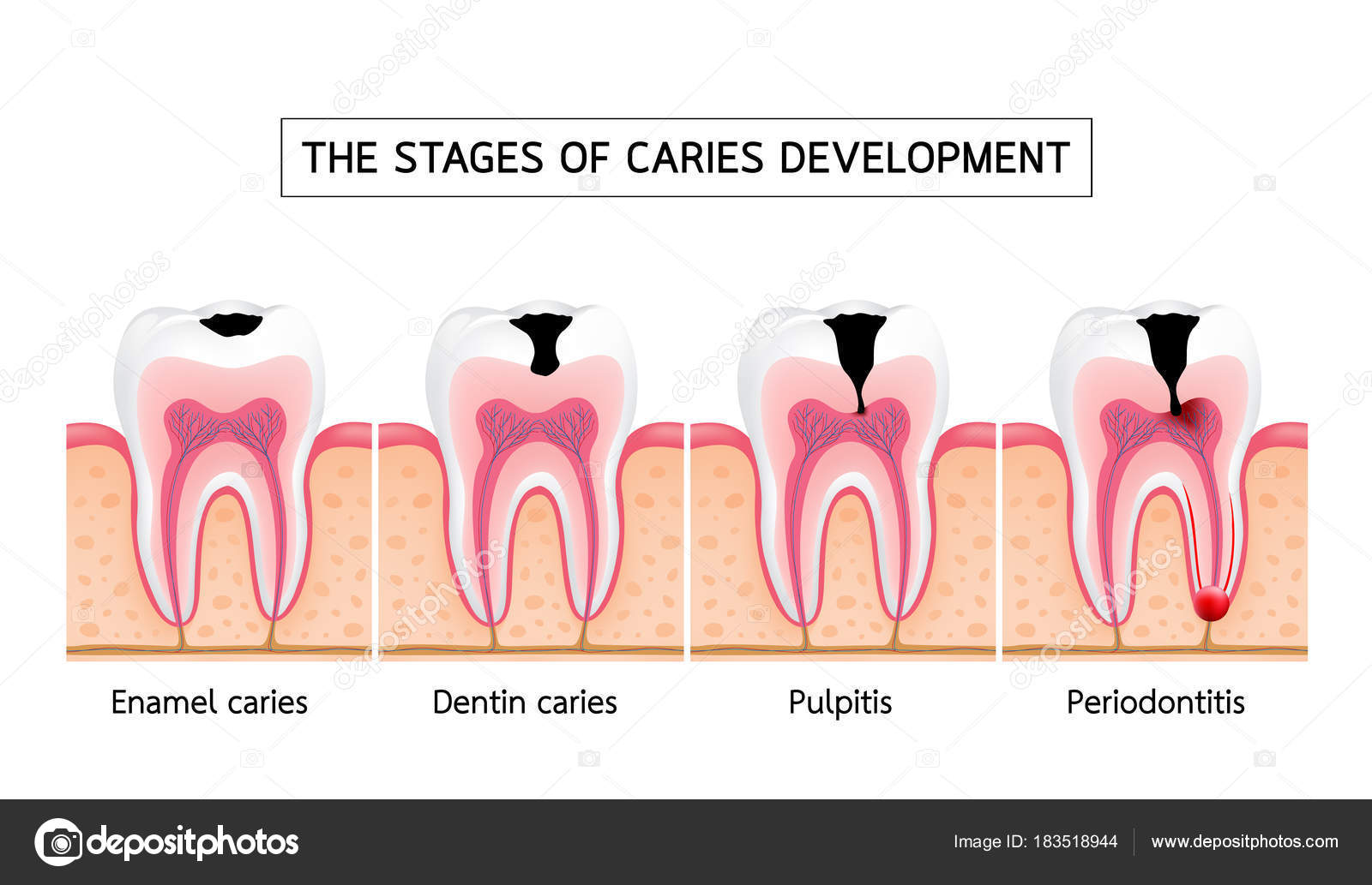 Estágios Desenvolvimento Cárie Cárie Esmalte Cárie Dentinária Pulpite ...
