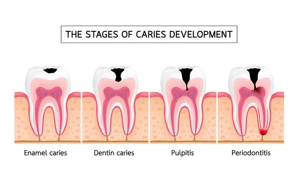 Stages Caries Development Enamel Caries Dentin Caries Pulpitis ...