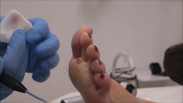 Dermatologist Surgeon Uses Electrocautery To Remove The Plantar Wart