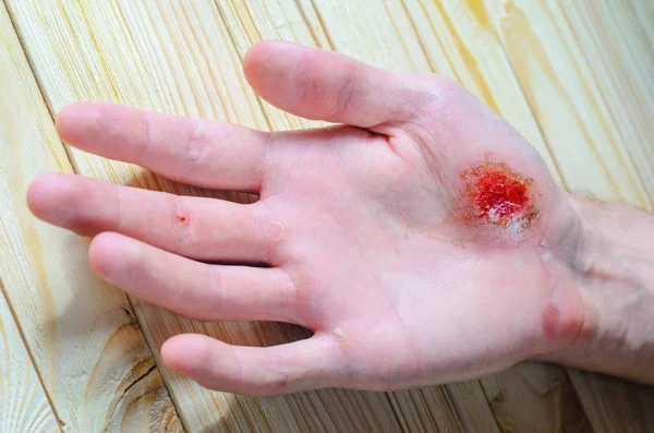 Abrasion. Deep wound on the skin — Stock Photo © V_Sot #157871410