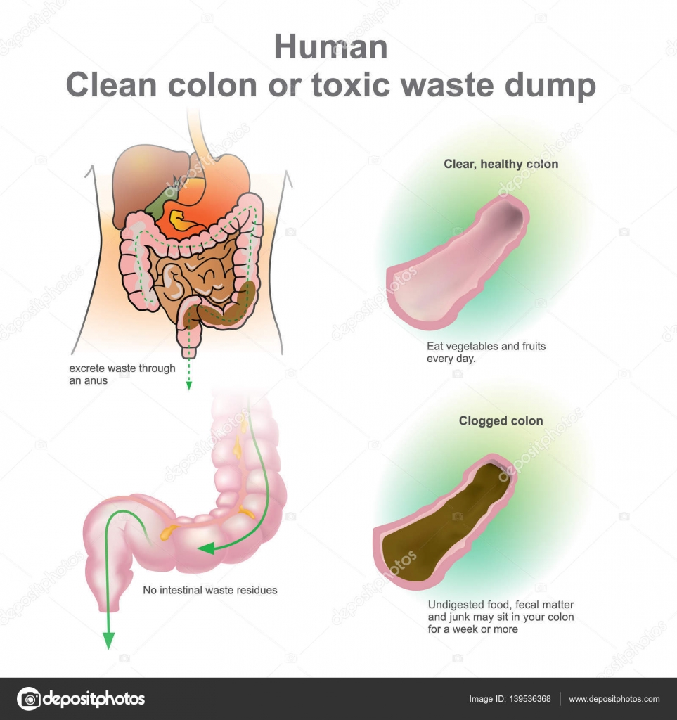 Man clogged colon, healthy colon. Vector, Illustration. Stock Vector ...