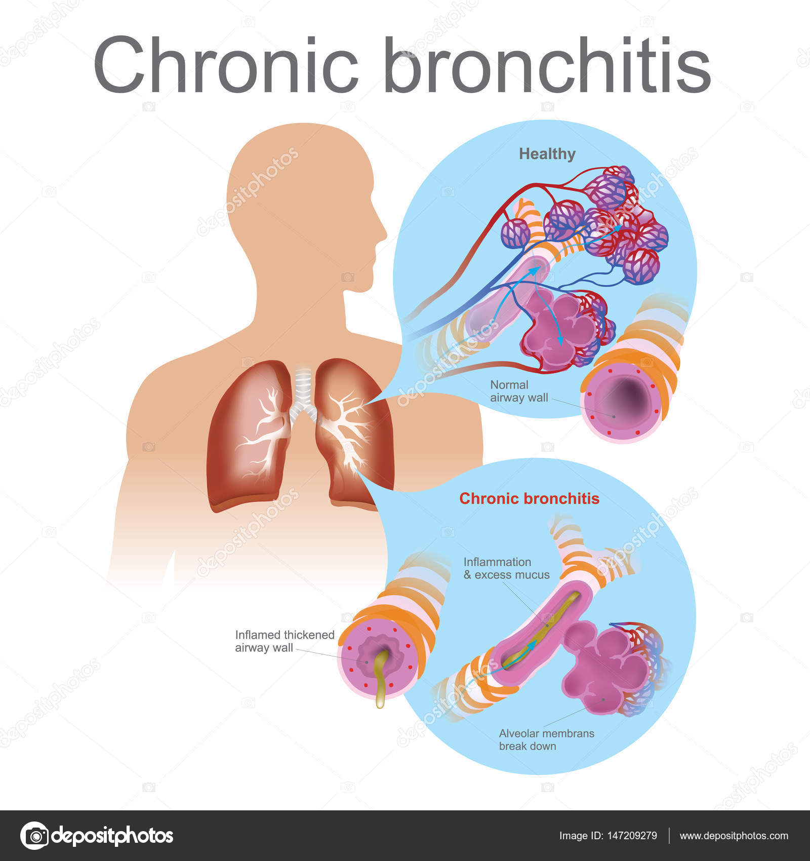 Bronquitis crónica.Vector gráfico, ilustrador vector, gráfico vectorial ...