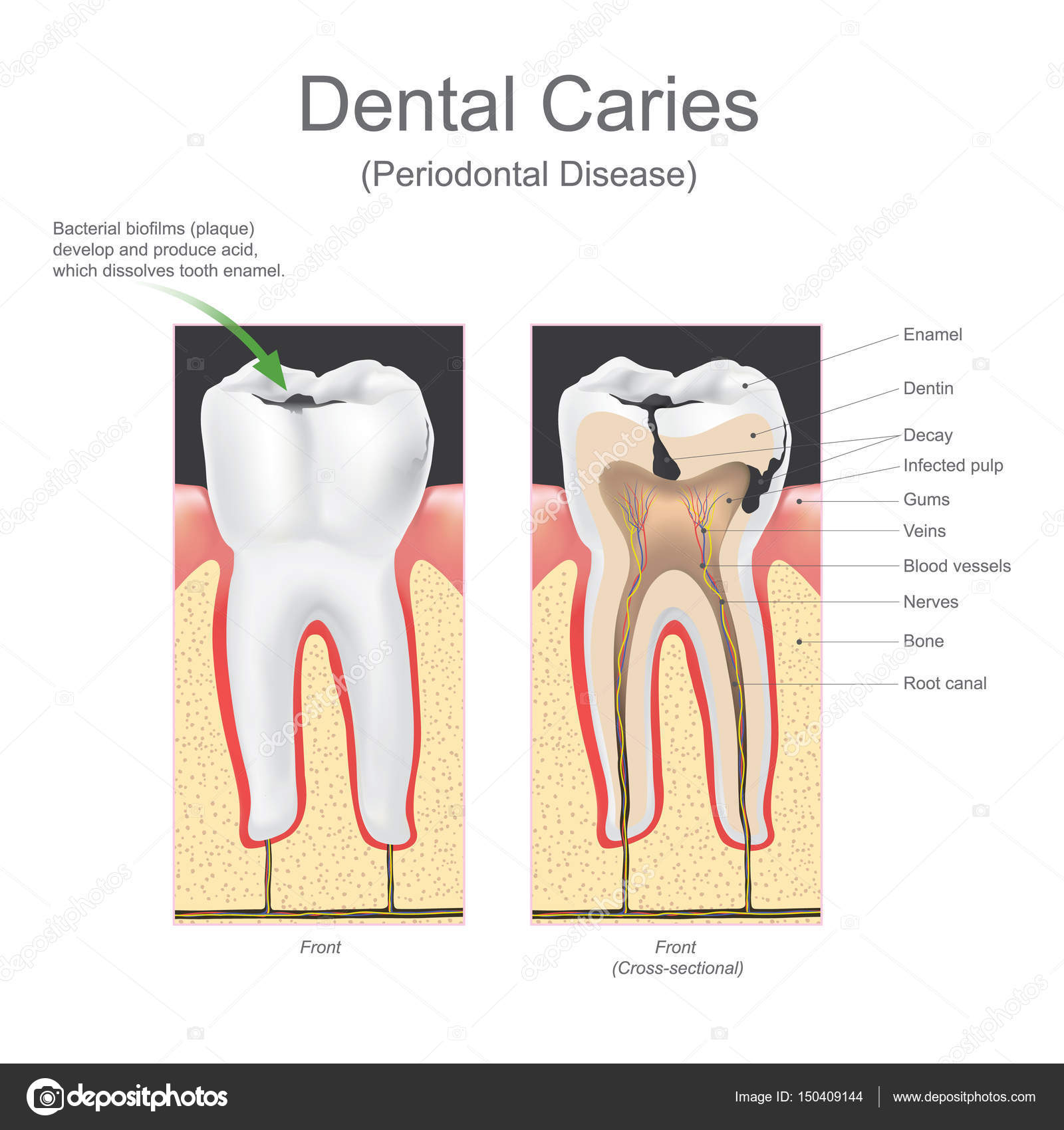 Dental caries periodontal disease. Stock Vector Image by ©pattarawit ...