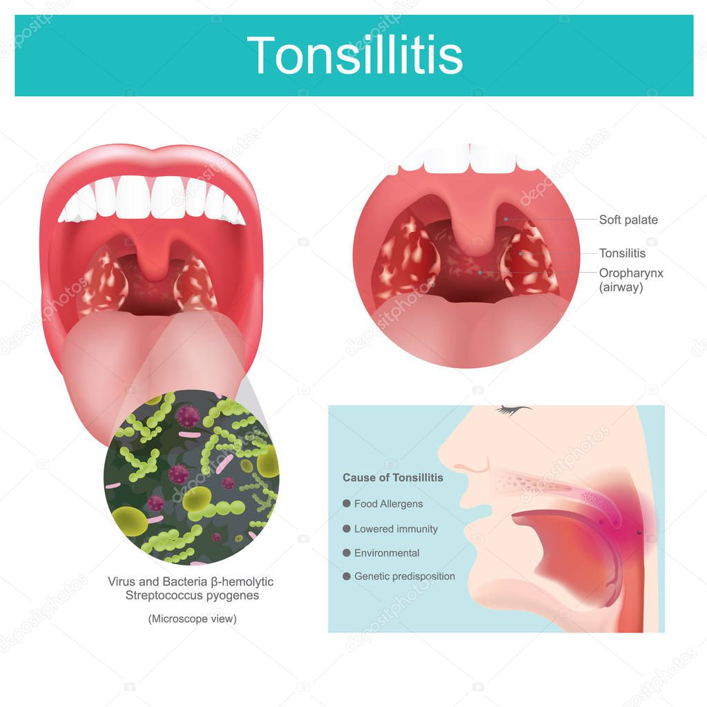 Amigdalitis. Se produce inflamación del tejido blando en la boca y ...