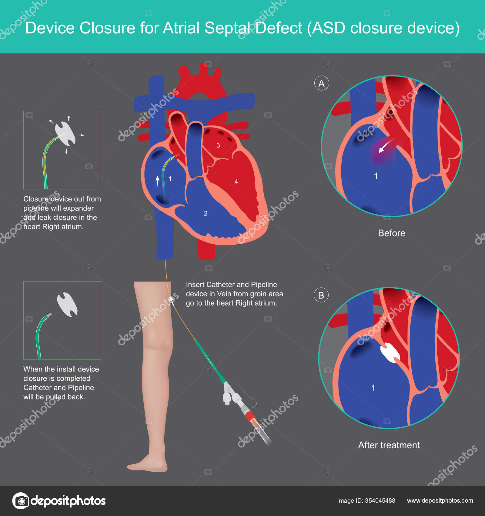 Devices Closure Atrial Septal Defect Explain Treatment Atrial Septal ...