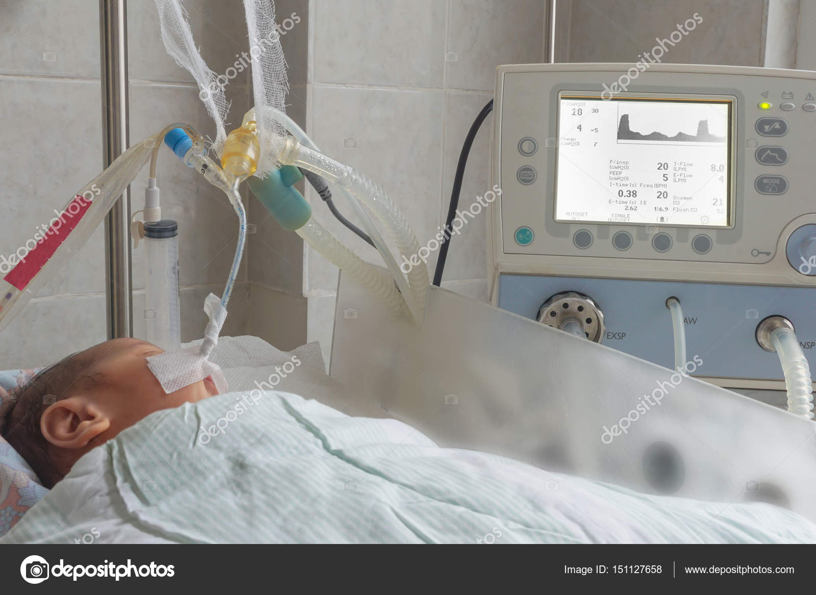 Ventilator Patient Child