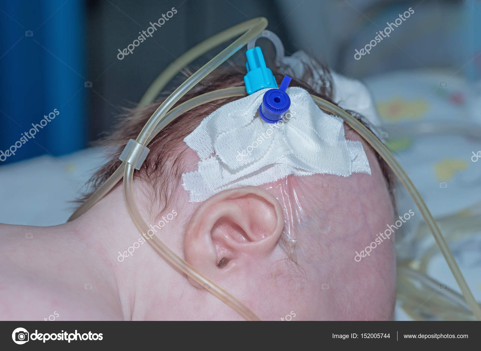 Peripheral intravenous catheter in the subcutaneous vein of newborn ...