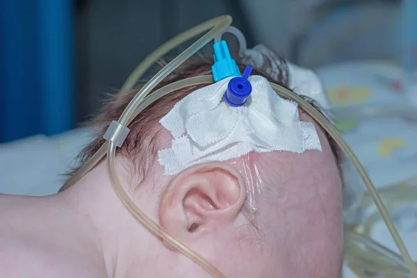 Peripheral intravenous catheter in the vein of newborn baby foot Stock ...