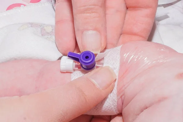 Peripheral intravenous catheter in the subcutaneous vein of newborn ...