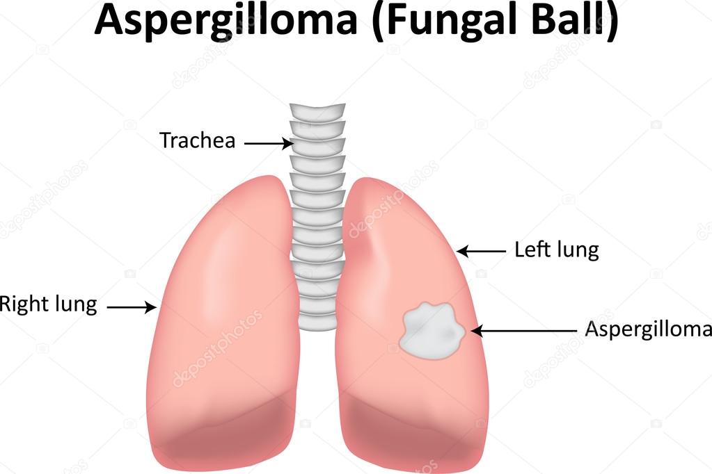 Aspergilloma Fungal Ball Infection In The Lungs — Stock Vector © Joshya123 124847628