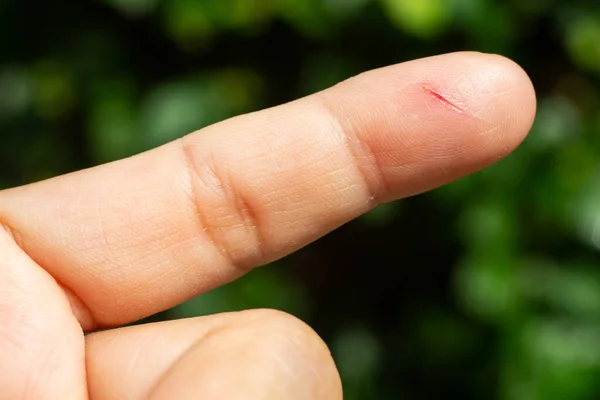 Finger Cut By Knife