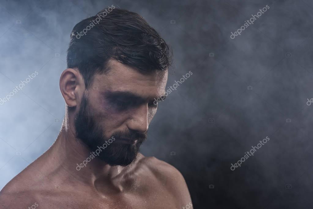 Picture: black man with black eye | Man with black eye — Stock Photo ...